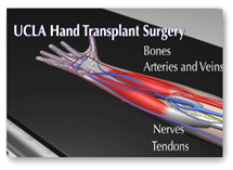UCLA Performs Hand Transplant - Health Works Collective
